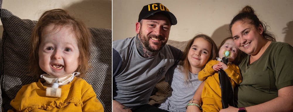 Isla, la nena de dos años que parece de ochenta por "la enfermedad de ...