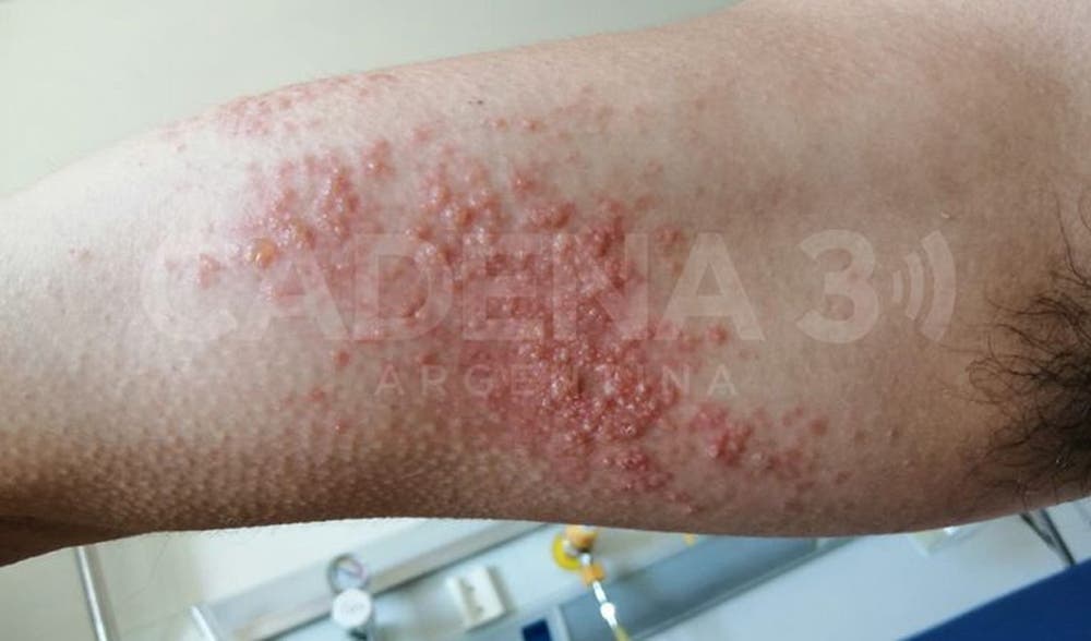 ️ ¿Por Qué Salen Sarpullidos En Las Axilas? Descubre La Verdad! ⚡ ...