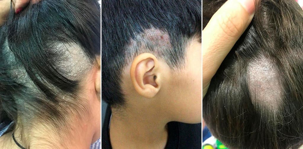 Definen como epidemia la proliferación de un hongo en las peluquerías ...