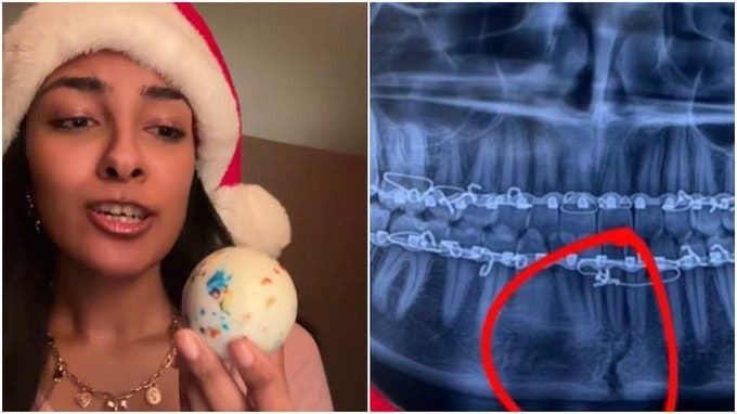 Quiso comer un caramelo, se rompió la mandíbula y lleva más de 40 días ...