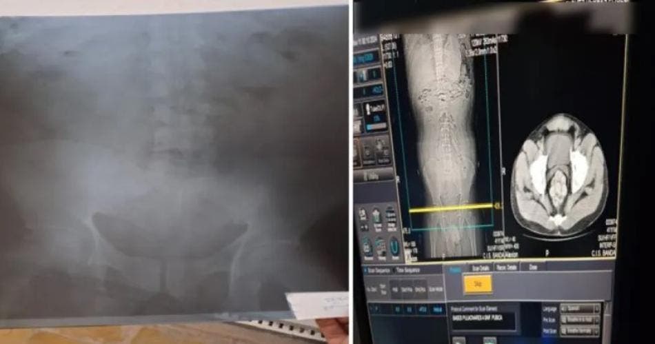 Mulas con más de cien cápsulas con droga en sus estómagos cayeron en ...